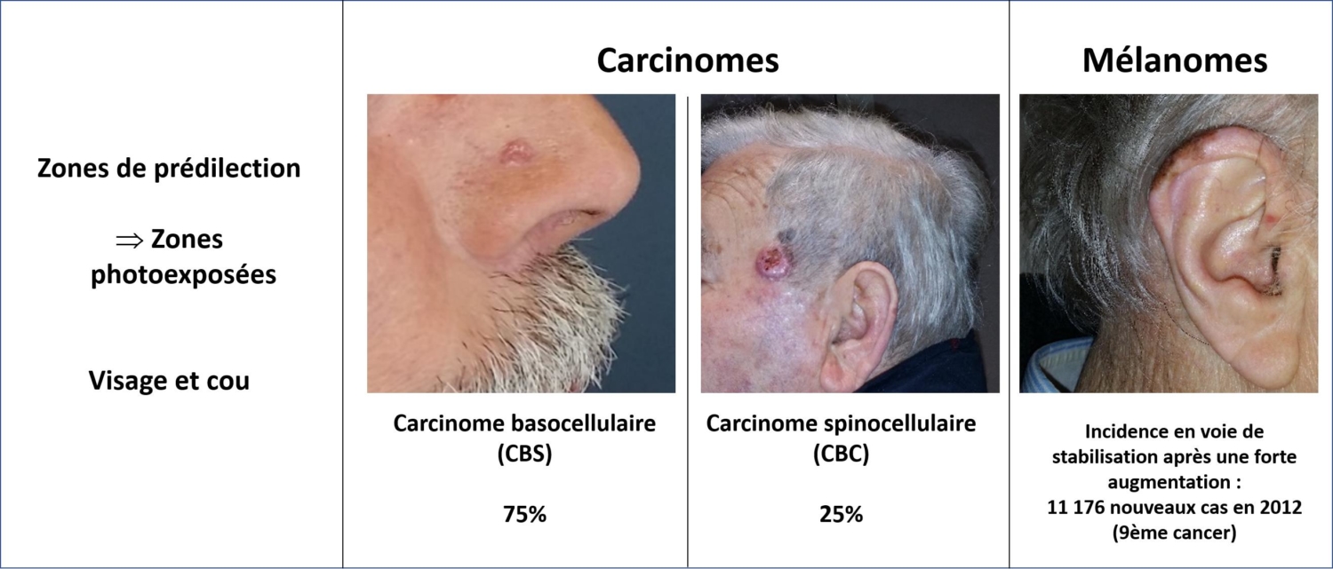 Chirurgien Tumeur de la Peau de la Face et du Cou à Nantes - Dr Chhuor
